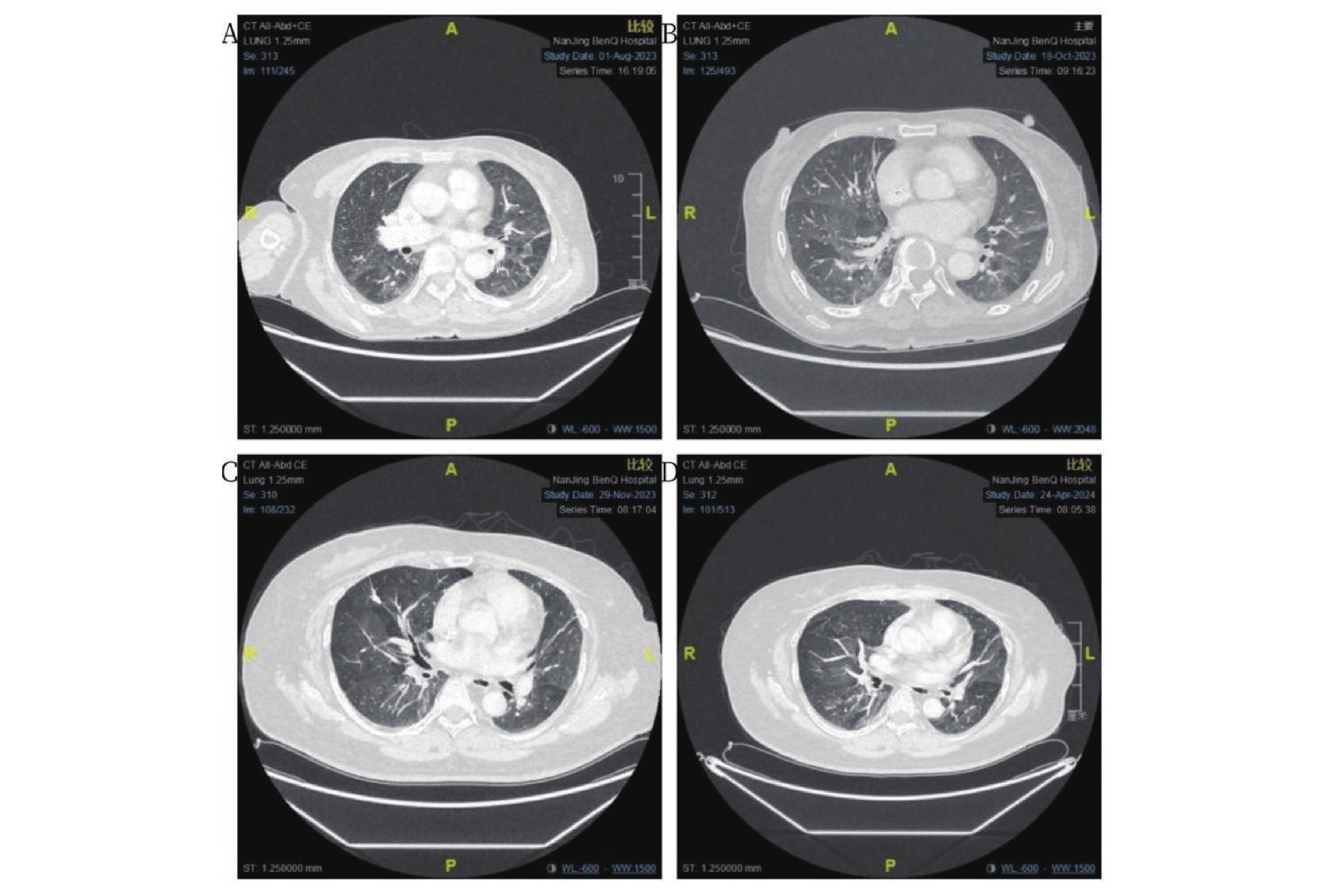 早期肺小气道损害能谱CT碘基值与FEV1/FVC的相关性