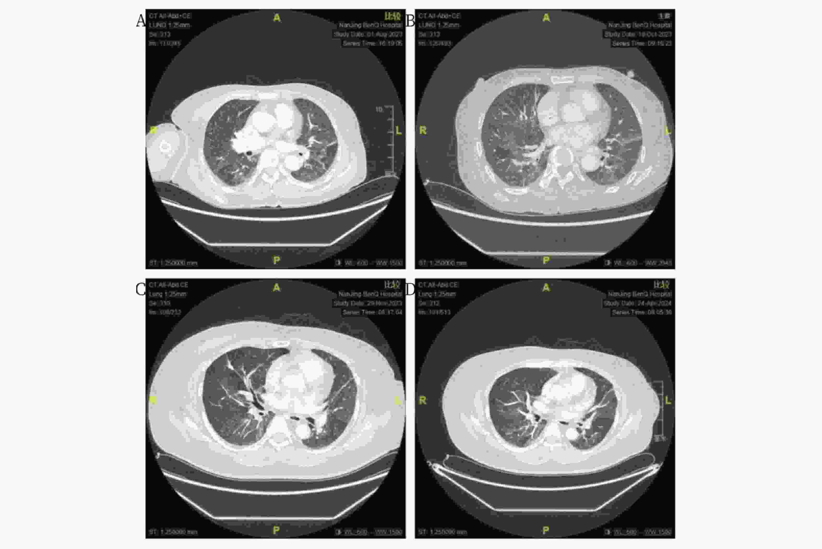 早期肺小气道损害能谱CT碘基值与FEV1/FVC的相关性